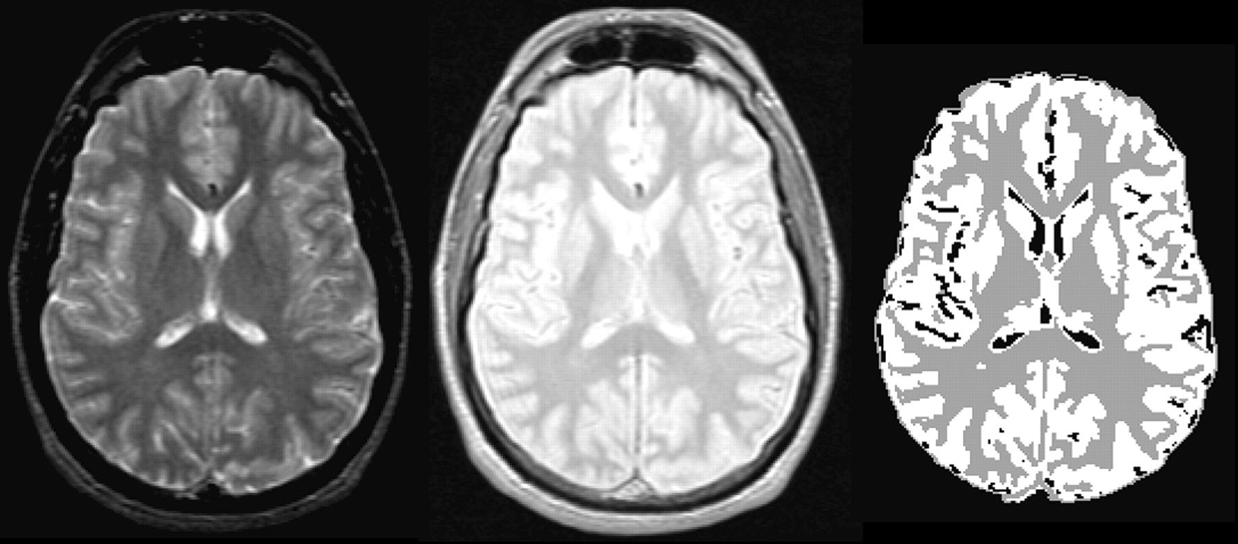 Qué es la materia blanca que compone la mitad de nuestro cerebro (y en ...